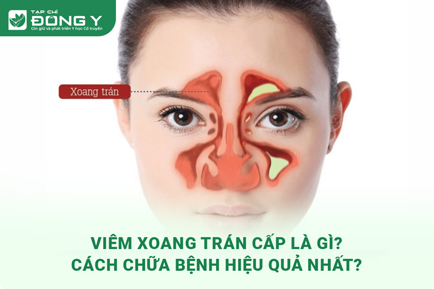 Viêm xoang sàng cấp: Nguyên nhân, triệu chứng, điều trị hiệu quả