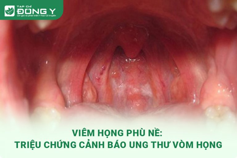 Viêm Họng Uống Thuốc Gì? Gợi Ý 7 Nhóm Thuốc Thường Dùng Nhất