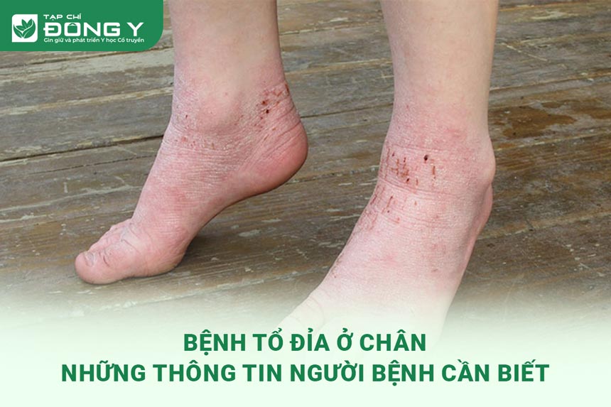 Chàm ở chân: Nguyên nhân, triệu chứng và cách điều trị hiệu quả