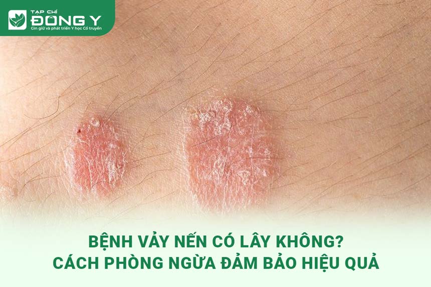 Bệnh vảy nến có lây không? Những điều cần biết