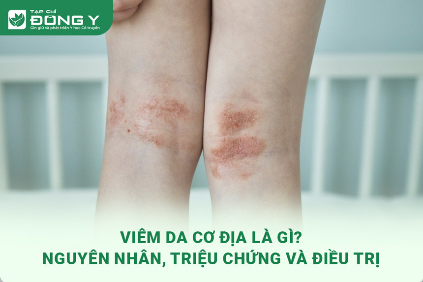 Chàm cơ địa ở trẻ em: Nguyên nhân và cách điều trị hiệu quả